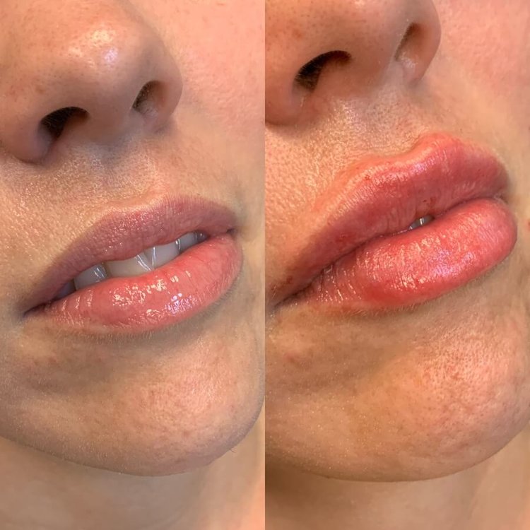 Botox And Fillers | Divine Health - OKLAHOMA