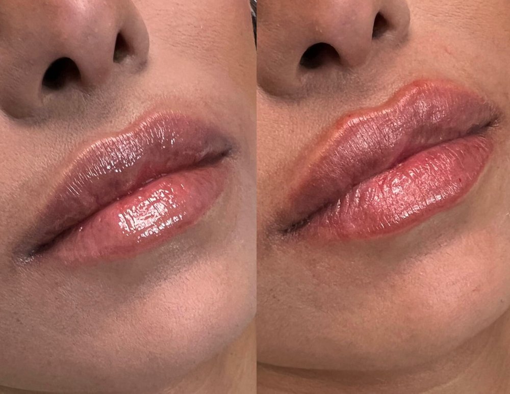 Botox And Fillers | Divine Health - OKLAHOMA